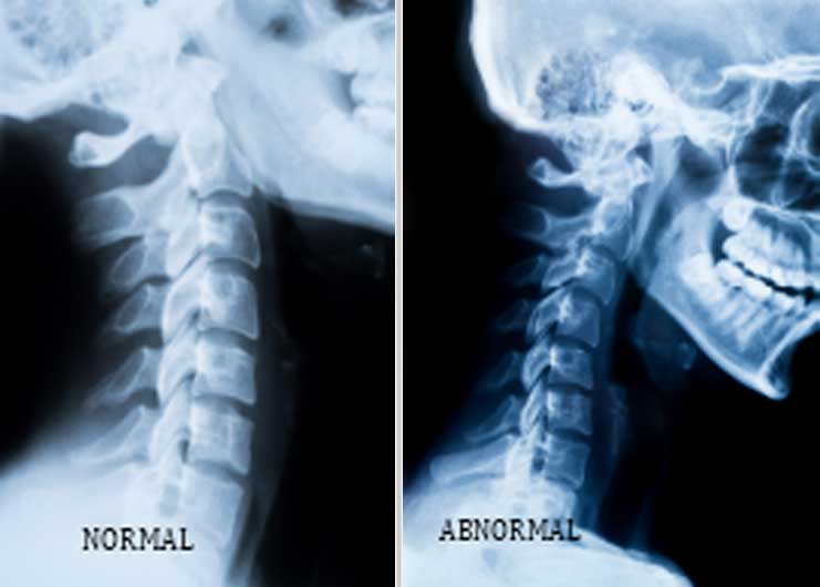 Headaches & Migraines Toronto | Transform Chiropractic