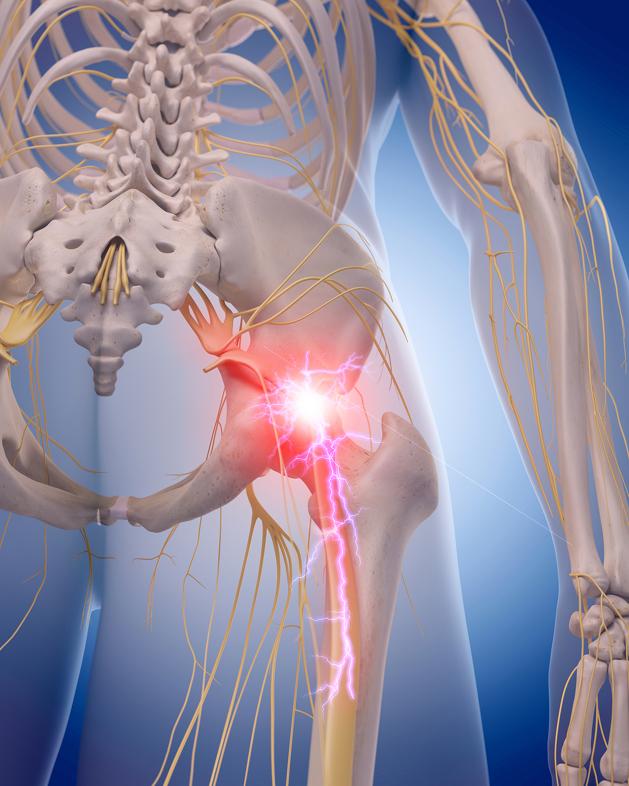 What is Sciatica and how do you treat Sciatic nerve pain?